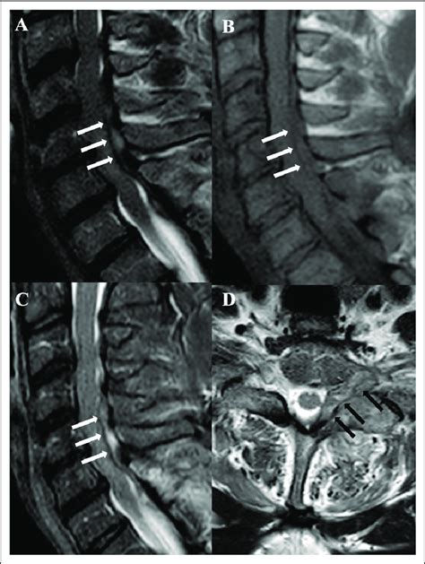 Sagittal Tse T2 A Tse T1 B Stir C And Axial Unenhanced Tse T1