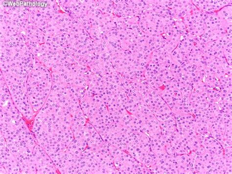 Oncocytoma Solid Pattern