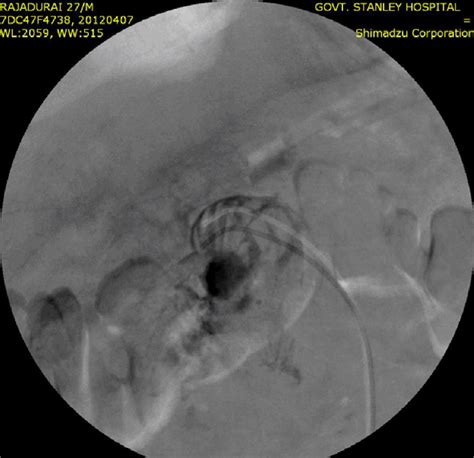 Contrast Extravasation From Pseudoaneurysm Into C Loop Of Duodenum