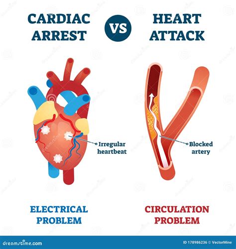 Cardiac Arrest Vs Heart Attack Vector Illustration Labeled Health