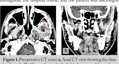 Figure 1 From Infratemporal Fossa Abscess Drainage Via A Trans Oral