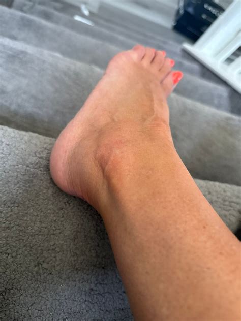 Susan Addison Torn Ligaments In The Ankle And Leg Watch Facebook