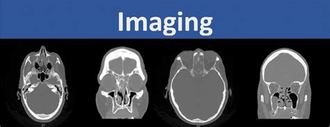 Ct Findings Included Enhancing Sinonasal Mass With Erosion Through The