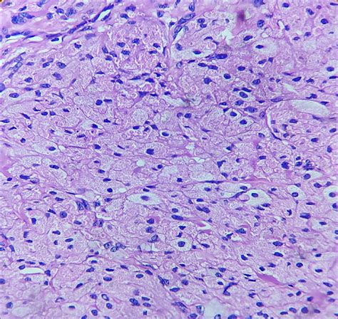 Densely Packed Cells With Abundant Pink Staining Cytoplasm With A Small