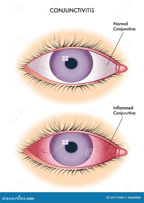 Conjunctivitis Stock Vector Illustration Of Inflammation 24711945