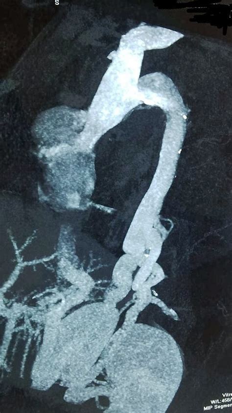 Interrupted Ivc With Azygos Continuation Sumers Radiology Blog