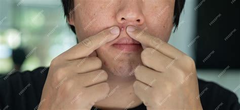 Premium Photo Closeup Acne On Face Skin Problem Scar And Oily On Face