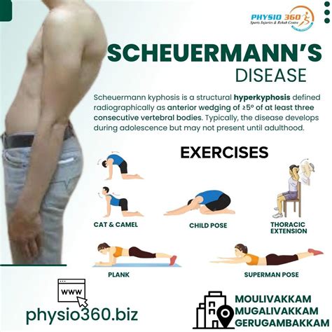 Physio360chennai On Linkedin Scheuermanns Disease Referred To As