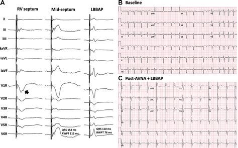 A Twelve Lead Electrocardiograms Ecg With Inverted Limb Leads And