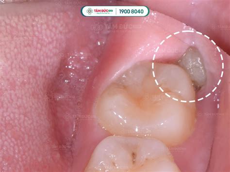 RĂng KhÔn CÓ MẤy ChÂn LÝ Do QuÝ KhÁch NÊn ChỤp Phim TrƯỚc Khi NhỔ RĂng