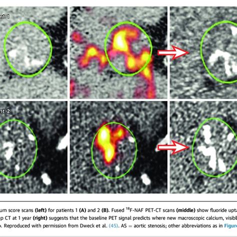 Myocardial Mass Quantification And Tissue Characterization By Cmr