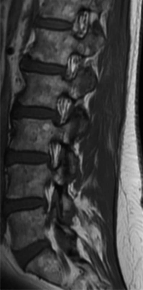 28 Diffusely Abnormal Marrow Signal Within The Vertebrae On Mri