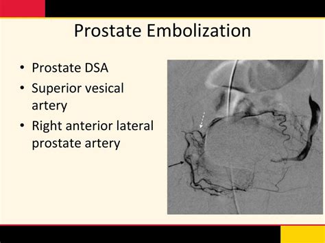 Prostate Embolization New Treatment Option For Bph Ppt Download