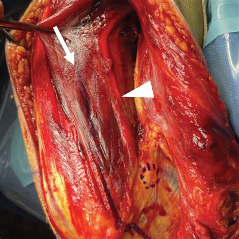 Unc Method In Practice Circled Area Is The Medial Epicondyle Of The Download Scientific