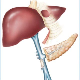 Reconstruction Of The Superior Mesenteric Vein Is Achieved With The