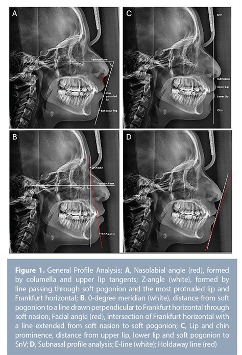 Correlation Between Cephalometric Values And Soft Tissue Profile In