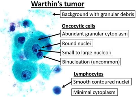 What Is The Difference Between Pleomorphic Adenoma And Warthin Tumor