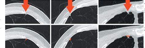 Figure 1 From Pleural Adhesion Assessment As A Predictor For Pneumothorax After Endobronchial