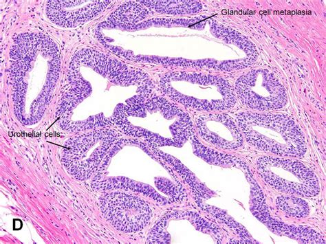 American Urological Association Urachal Remnant
