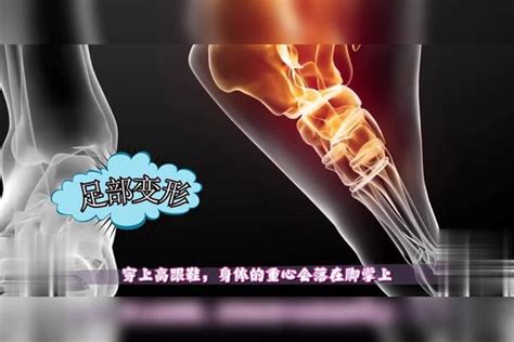 高跟鞋穿久了，会对女生产生危害吗？看完难以置信高跟鞋女生危害