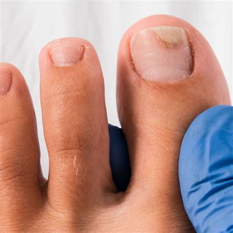 Fingernail Fungus Treatment Home Remedies