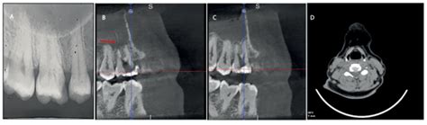Separation Of Endodontic Instrument A A Preoperative Radiograph That