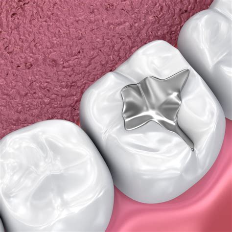 Metal Fillings Replacement Golden Square Dental