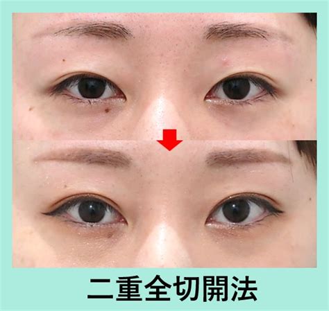 二重全切開法 』でナチュラルな可愛い目元に Womクリニック銀座