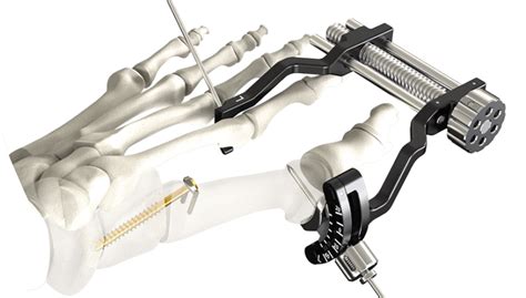 Extremity Medical Introduces Freedom Lapidus Implants