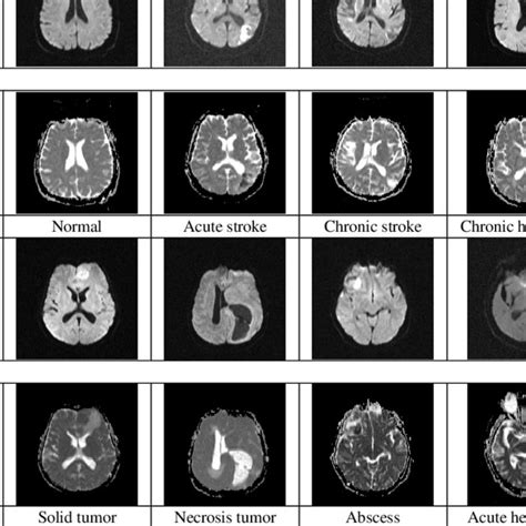 Pdf Review Of Brain Lesion Detection And Classification Using Neuroimaging Analysis Techniques