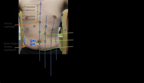 Disposition Des Marqueurs Sur Labdomen Et Emg Download Scientific