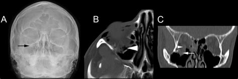 Blow Out Fracture In A 29 Year Old Woman A Teardrop Sign