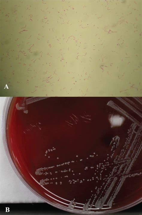 Caulobacter Species As A Cause Of Postneurosurgical Bacterial