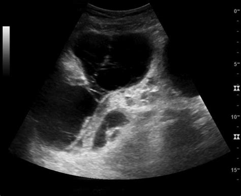 Radiological Case Cystic Lymphangioma Applied Radiology