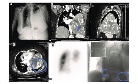 A Preoperative Chest X Ray Left Side Uniformly White With