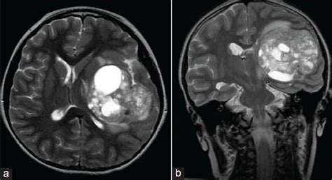 Axial T2 Weighted Mri Shows A Heterogeneous Predominantly Hyperintense