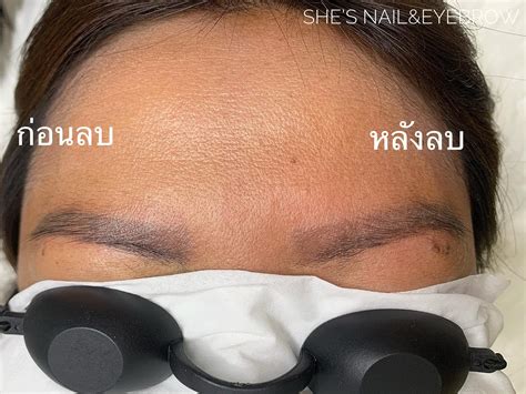 ดูชัดๆ หลังลบคิ้วด้วยเครื่องเลเซอร์ ไม่มีแผล ไม่บวม ไม่มีเลือด ลบคิ้ว บ้านรักษ์คิ้ว สัก