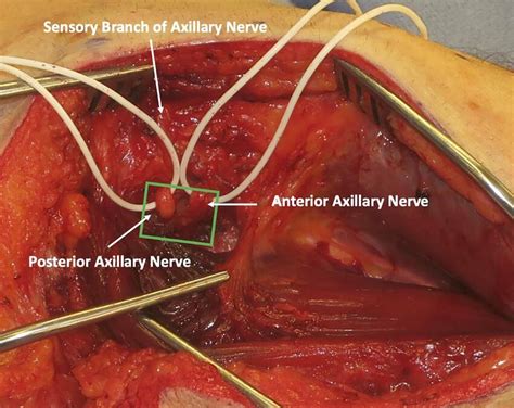 View Of The Axillary Nerve Emerging From The Quadrangular Space The