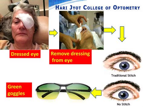 Intracapsular Cataract Extraction Pptx