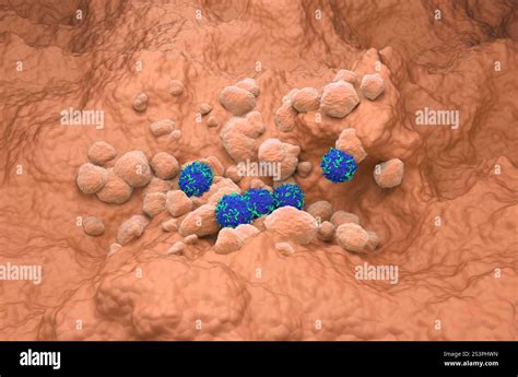 Non Small Cell Lung Cancer Nsclc In The Lung Tissue Isometric View 3d Illustration Stock