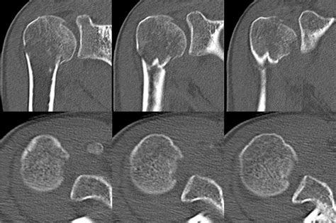 Original Ct Scan Showing Impression Fracture And Surgical Neck Download Scientific Diagram