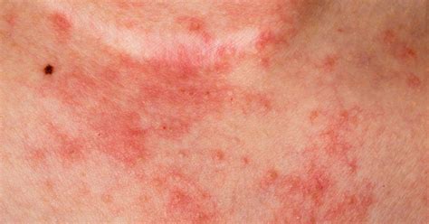 6 tipos de eczema síntomas y causas