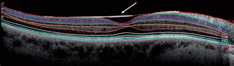 Segmentation Of Retinal Layers Sd Oct Arrow Hyperreflective Band Of