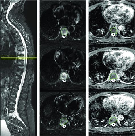 Sagittal Short Tau Inversion Recovery Stir Of The Spine Showing