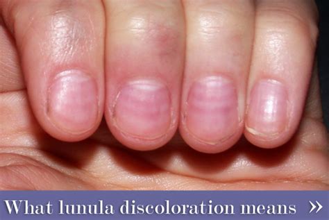 Discoloured Toenails From Nail Polish Nail Ftempo