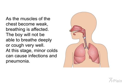 Patedu Muscular Dystrophy Duchenne