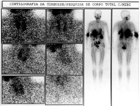 M Tc Mibi Scintiscan Of Thyroid And Of Total Body Showed A Normal Topic