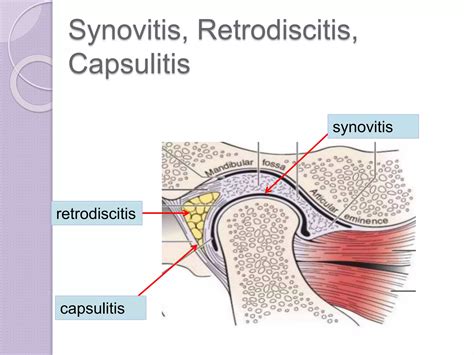 Tmj Temporomandibular Joint Disorders Pptx