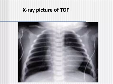 Cyanotic Congenital Heart Diseases Ppt