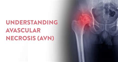 Know Everything About Understanding Avascular Necrosis Avn Ck Birla